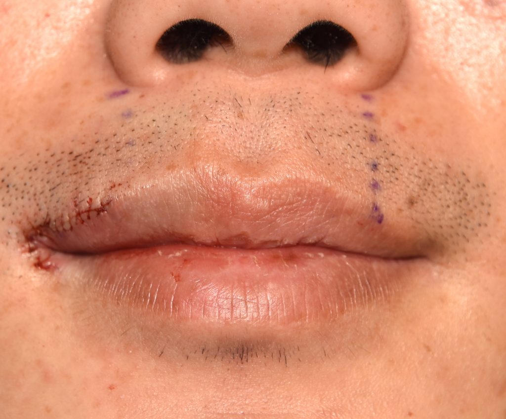 right mouth corner lateral upper lip lift result Dr Barry Eppley ...