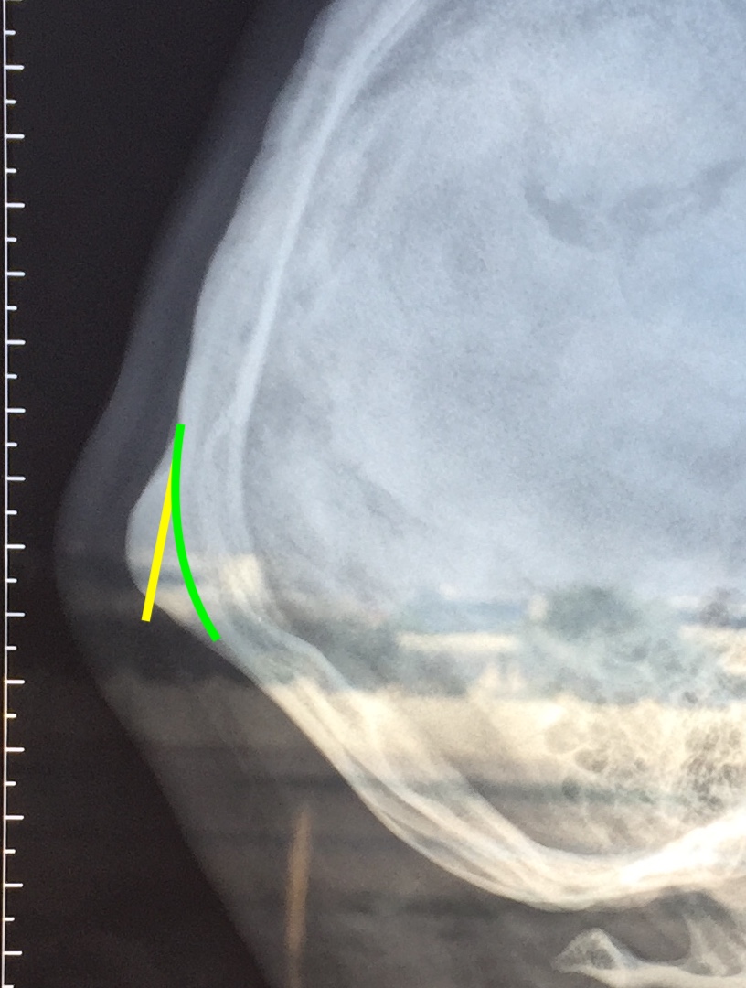 Technical Strategies - Complete Reduction of the Occipital Knob Skull ...