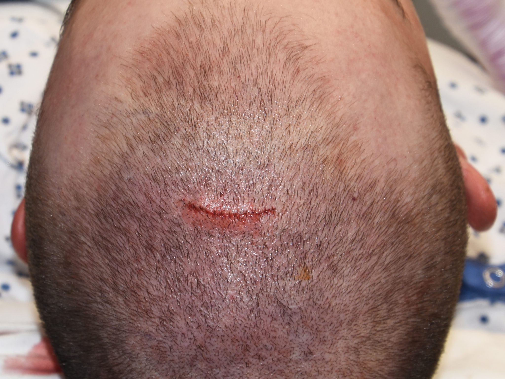 Plastic Surgery Case Study - The Coronal Dip Custom Skull Implant ...