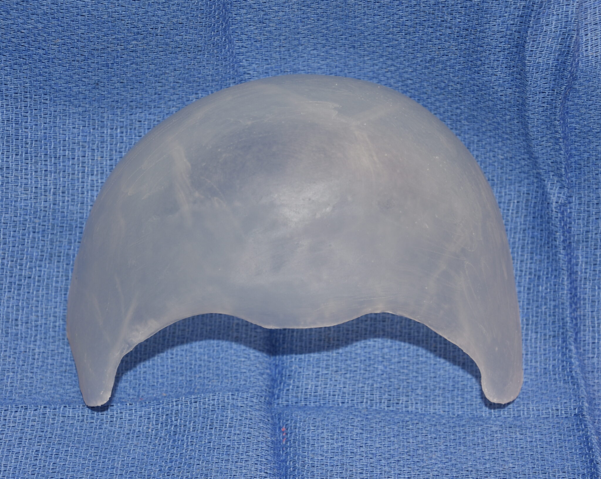 Plastic Surgery Case Study - Female Custom Widening Forehead-Temporal ...