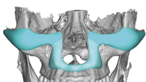 Custom midface implant design front view Dr Barry Eppley Indianapolis ...