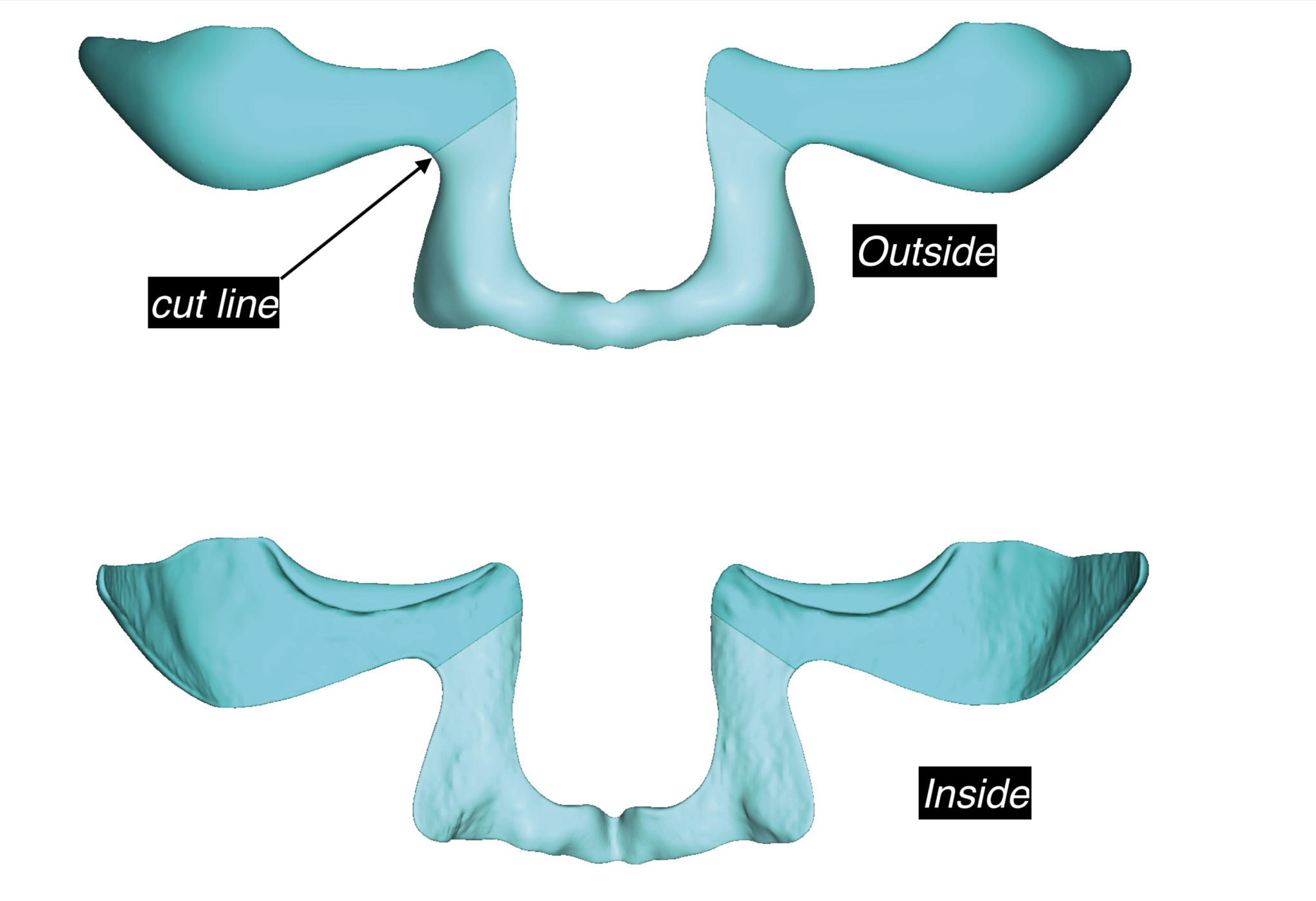 Plastic Surgery Case Study - Custom Midface (Infraorbital-Malar ...