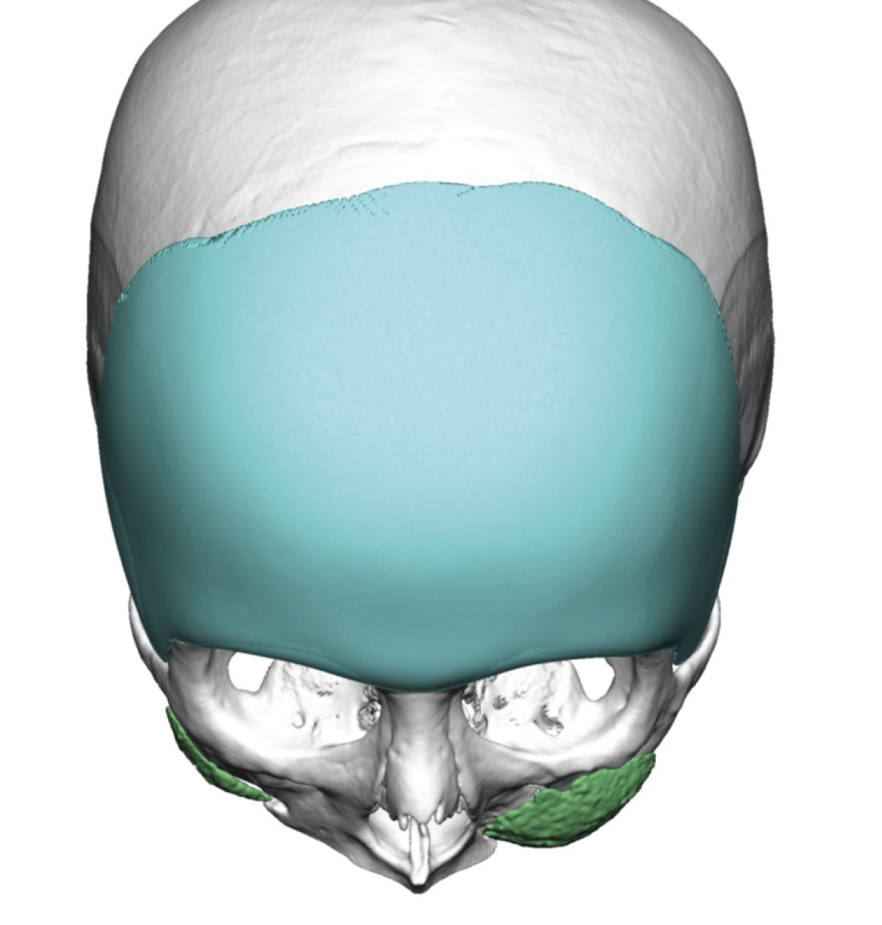 Plastic Surgery Case Study - Female Custom Widening Forehead-Temporal ...