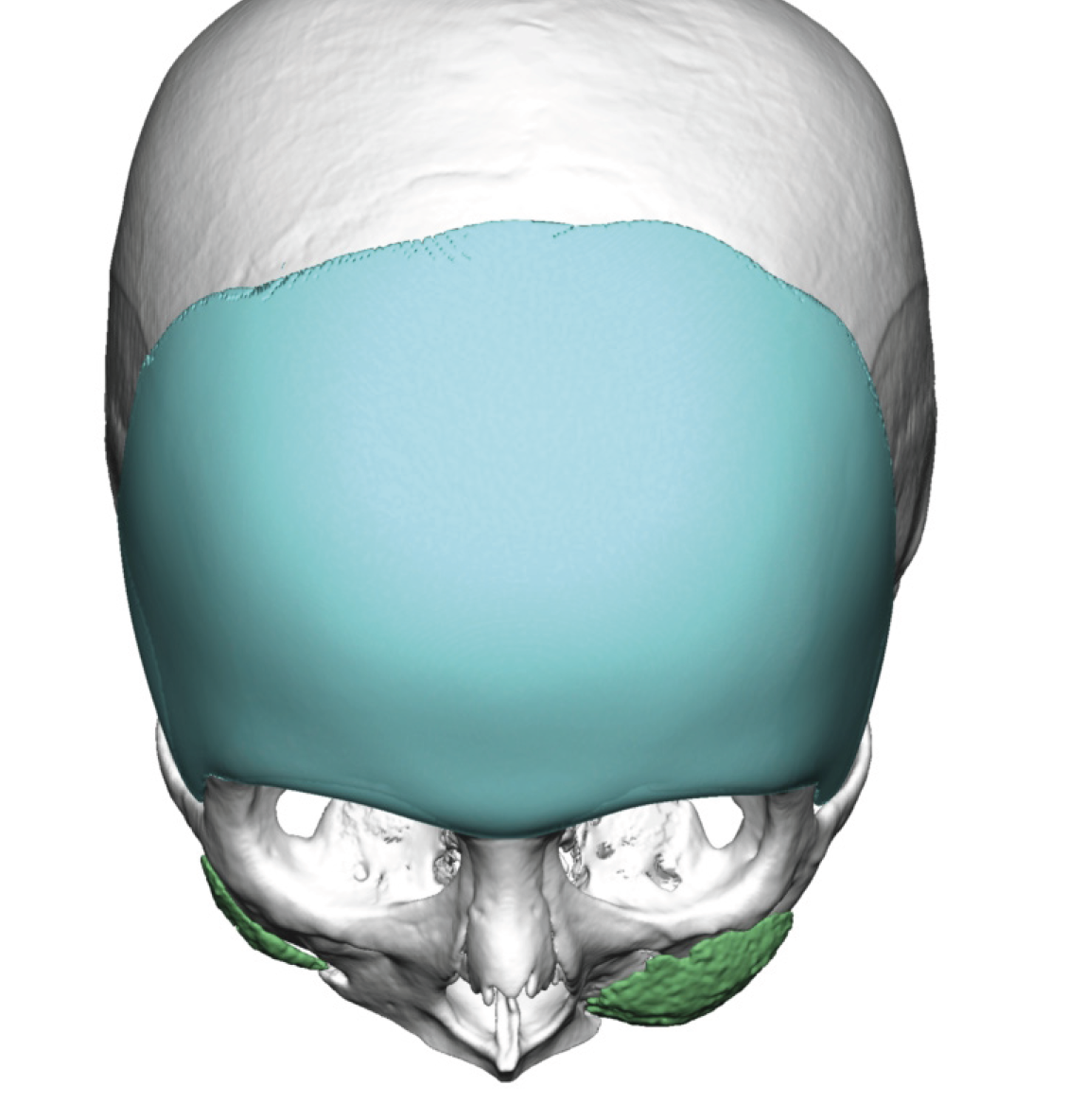 Plastic Surgery Case Study - Female Custom Widening Forehead-Temporal ...