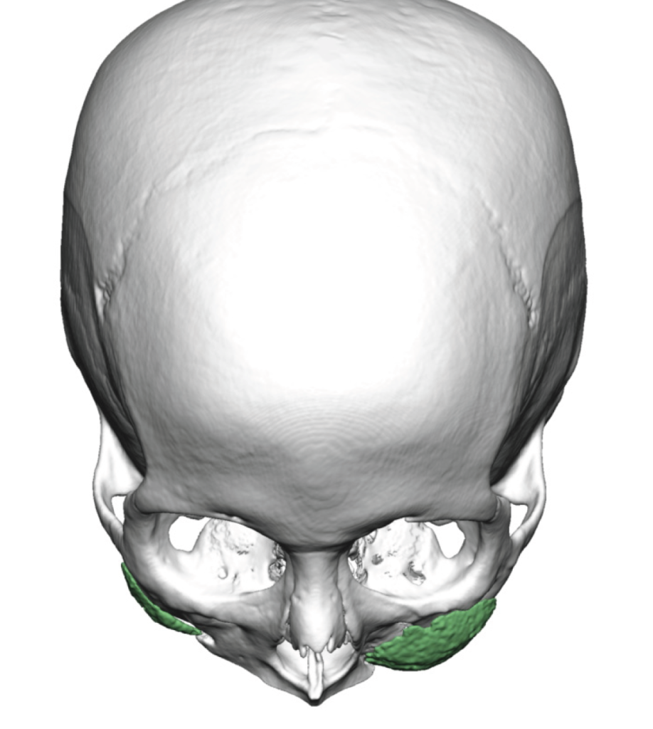 Plastic Surgery Case Study - Female Custom Widening Forehead-Temporal ...