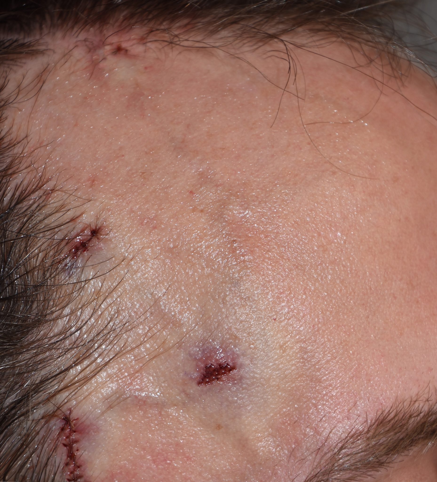 The Immediate Results of Multilevel Temporal Artery Ligations For ...