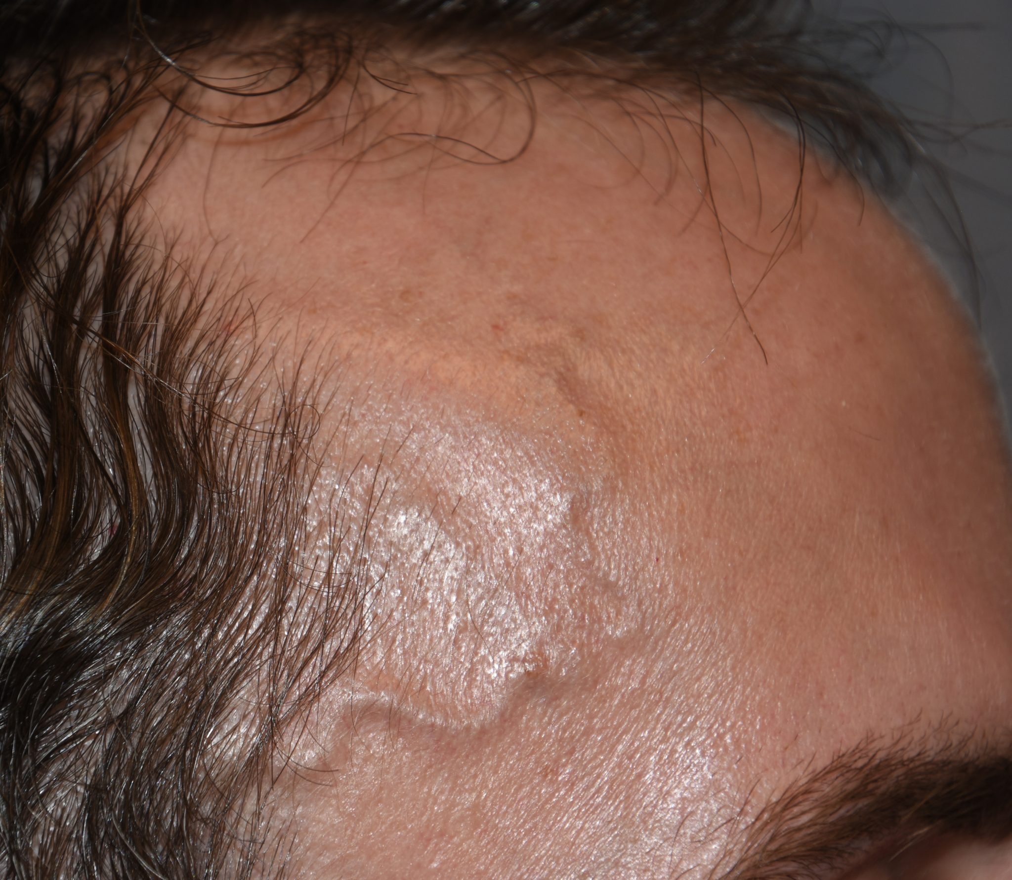 The Immediate Results of Multilevel Temporal Artery Ligations For ...