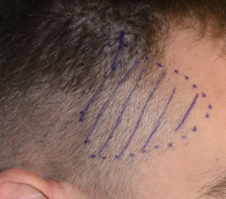 Technical Strategies - Thermal Reduction of Anterior Temporal Muscle ...