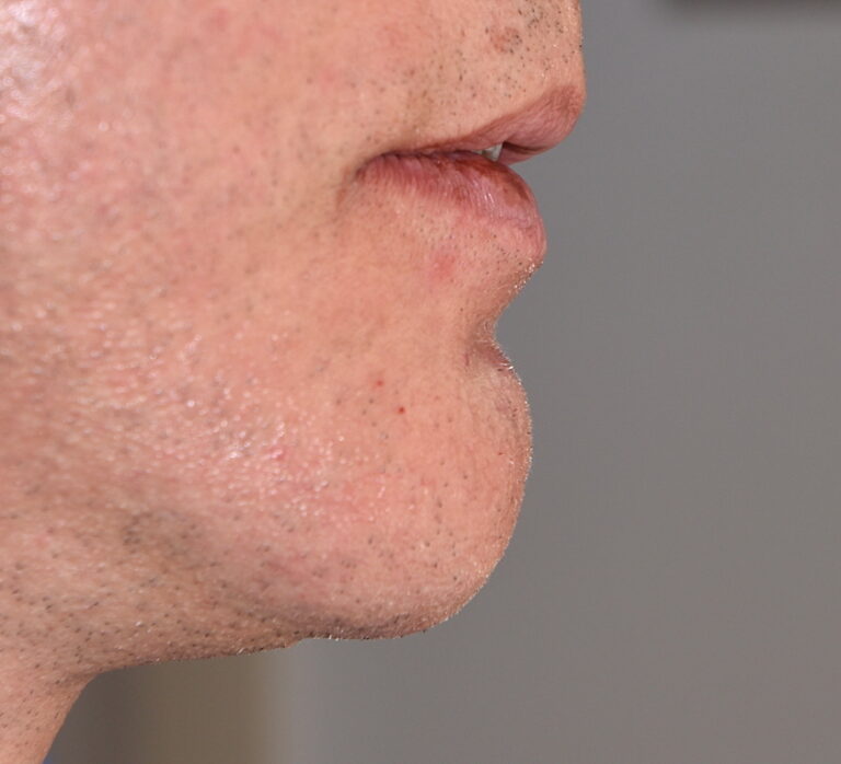 Plastic Surgery Case Study - Labiomental Sulcus Contracture Release ...