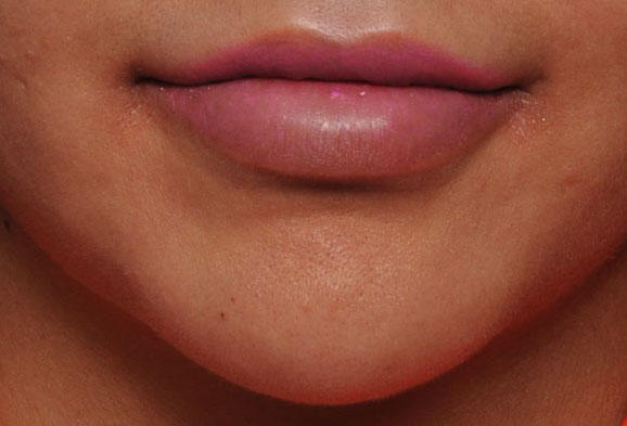 Plastic Surgery Case Study - Female Tapered Chin Implant Augmentation ...