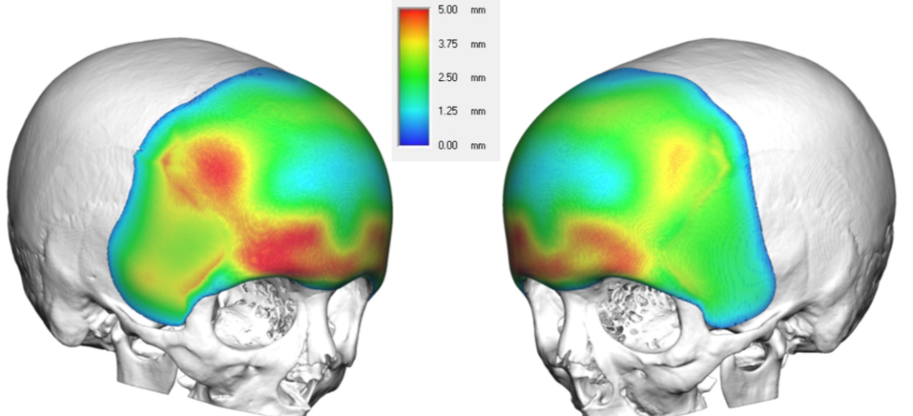 Plastic Surgery Case Study - Female Custom Widening Forehead-Temporal ...