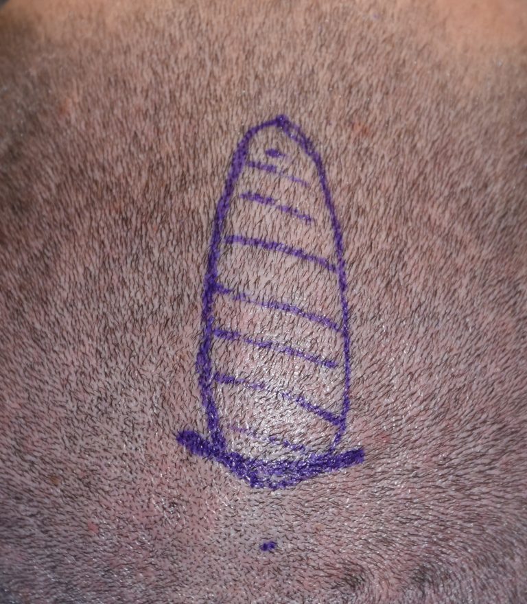 Technical Strategies - Posterior Sagittal Ridge Skull Reduction ...