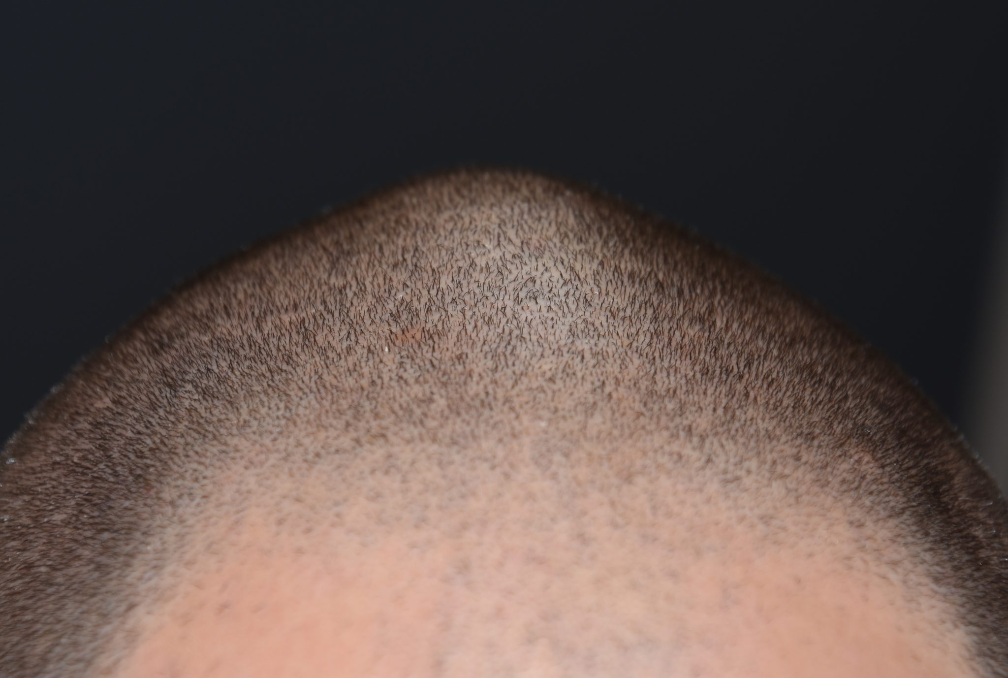 posterior sagittal ridge skull deformity front view Dr Barry Eppley ...