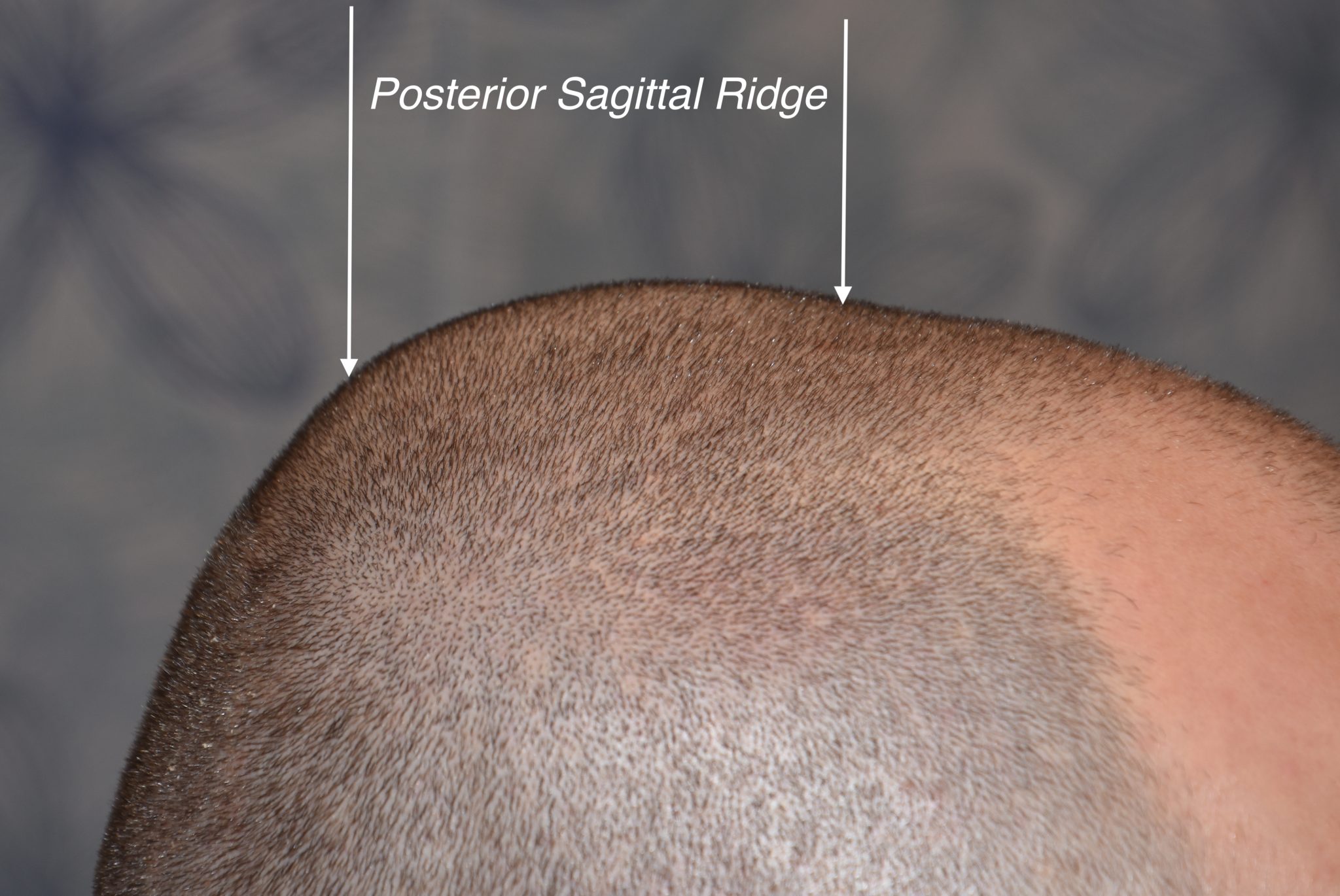 posterior sagittal ridge skull deformity side view Dr Barry Eppley ...