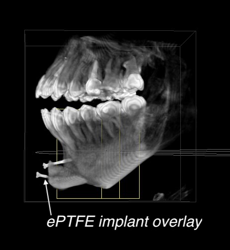 Plastic Surgery Case Study: Subtotal Sliding Genioplasty Reversal with ...