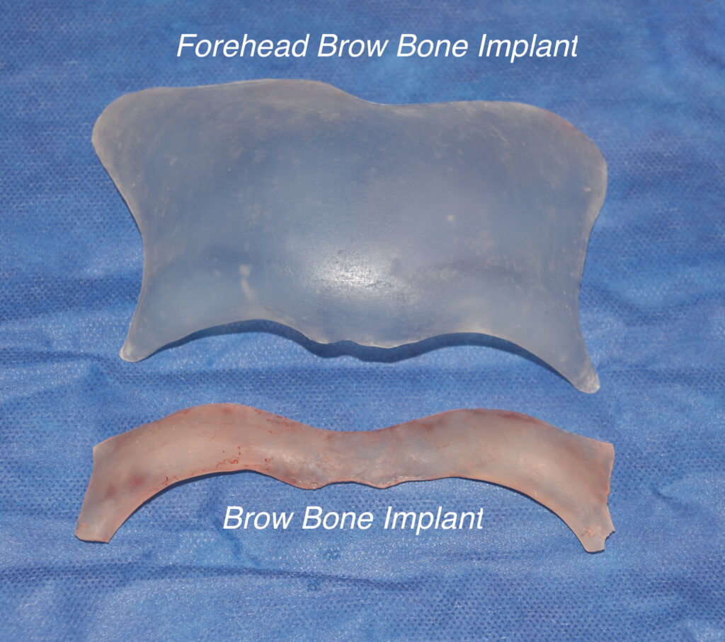 Plastic Surgery Case Study - Custom Forehead Brow Bone Implant ...