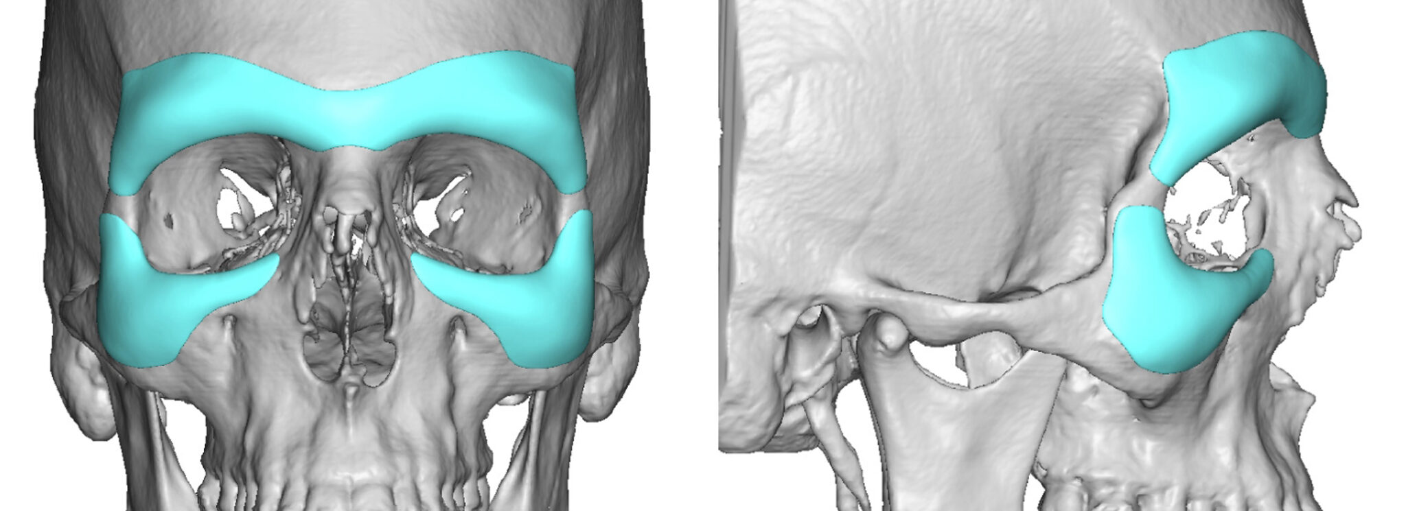 Plastic Surgery Case Study - Custom Forehead Brow Bone Implant ...