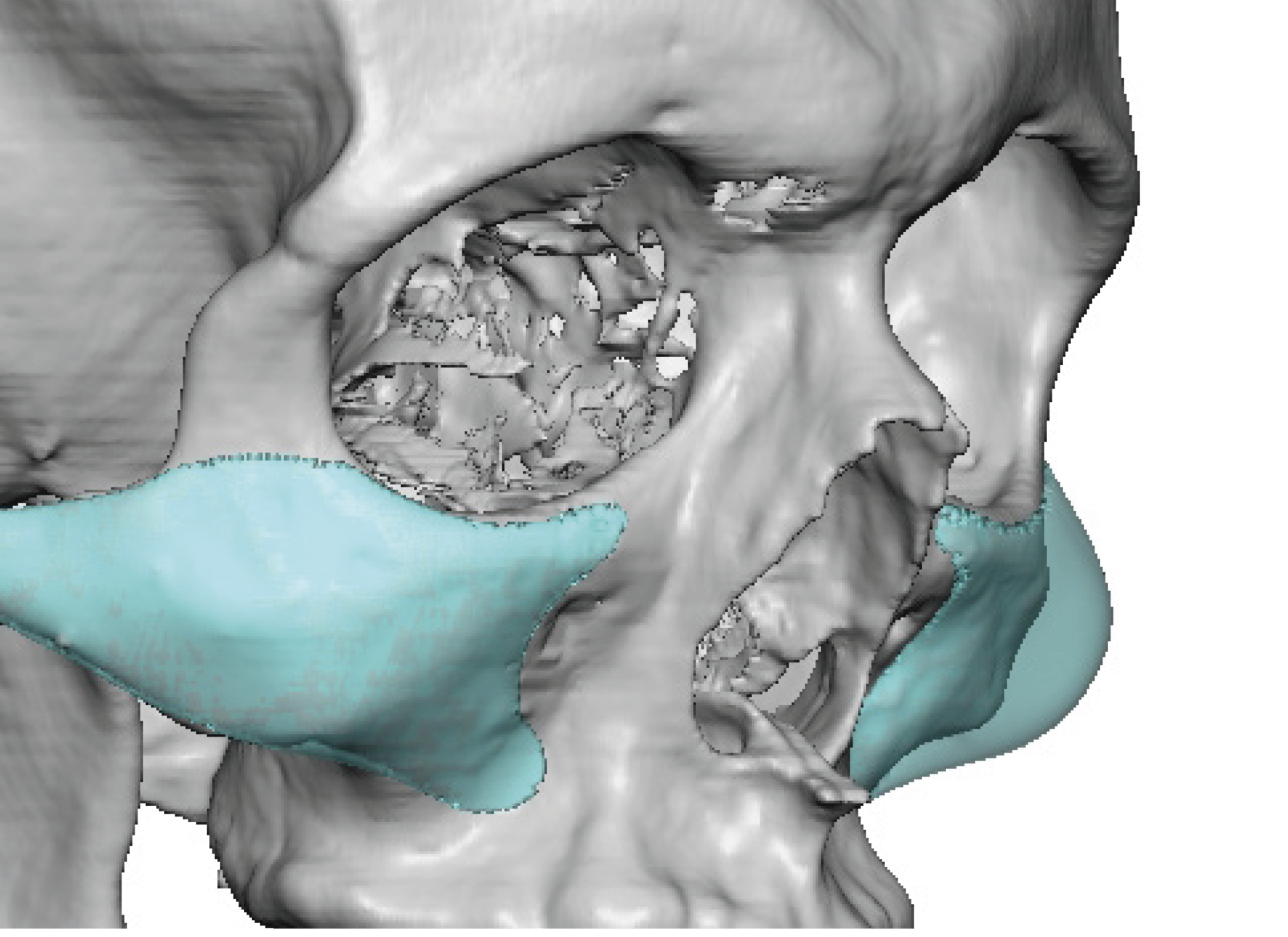 Custom Cheek and Jawline Implants for Male Masculinization - Explore ...