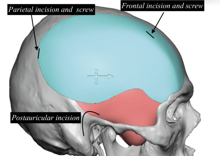 Custom Forehead-Temporal Widening Implant In The Male With A Narrow ...