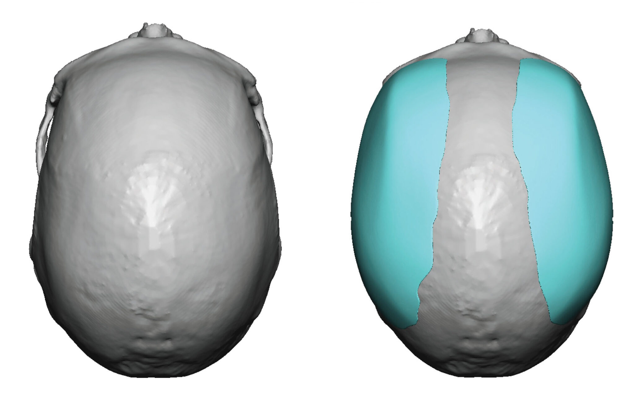 Custom Forehead-Temporal Widening Implant In The Male With A Narrow ...
