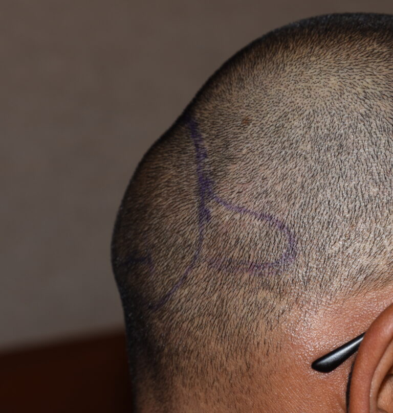 Plastic Surgery Case Study - Occipital Skull Reduction with Parietal ...