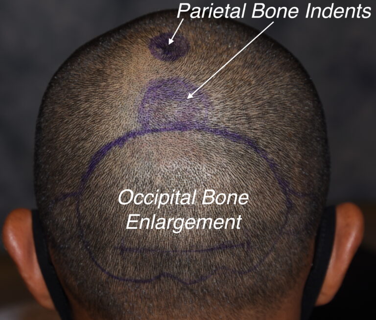 Plastic Surgery Case Study - Occipital Skull Reduction with Parietal ...