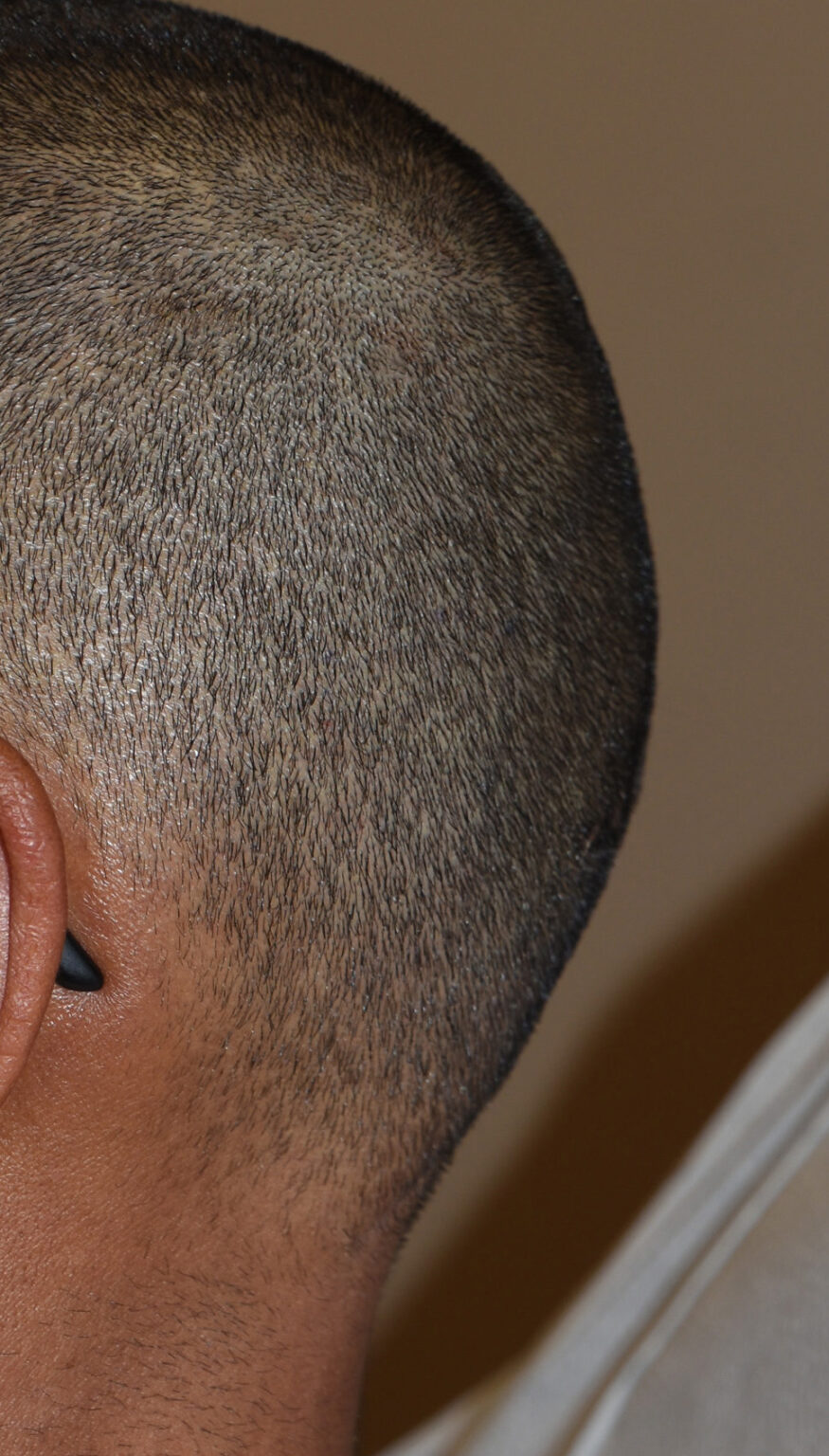 Plastic Surgery Case Study - Occipital Skull Reduction with Parietal ...