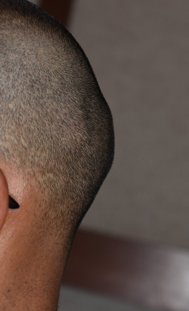 Plastic Surgery Case Study - Occipital Skull Reduction with Parietal ...
