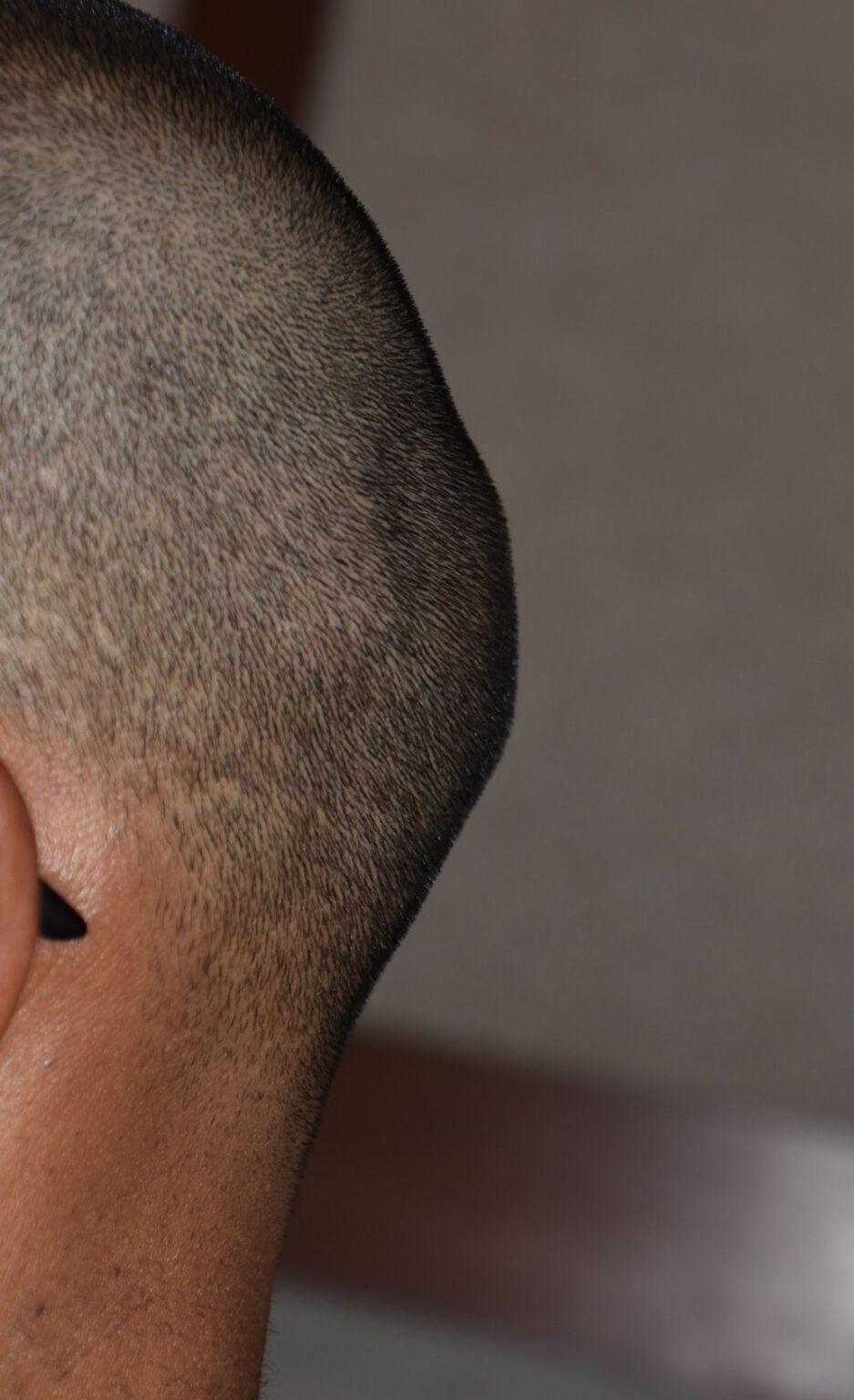 Plastic Surgery Case Study - Occipital Skull Reduction with Parietal ...