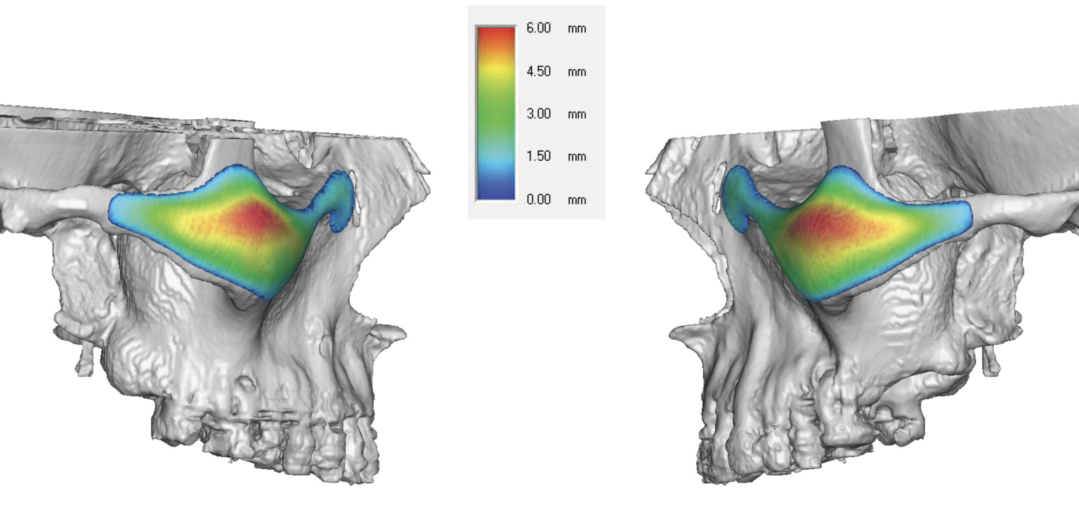 Technical Strategies - Intraoperative Modification of Custom ...