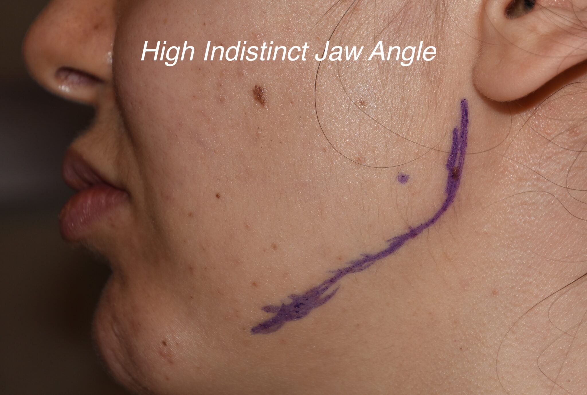female high jaw angle jawline Dr Barry Eppley Indianapolis - Explore ...