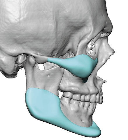 Custom Cheek and Jawline Implants for Male Masculinization - Explore ...
