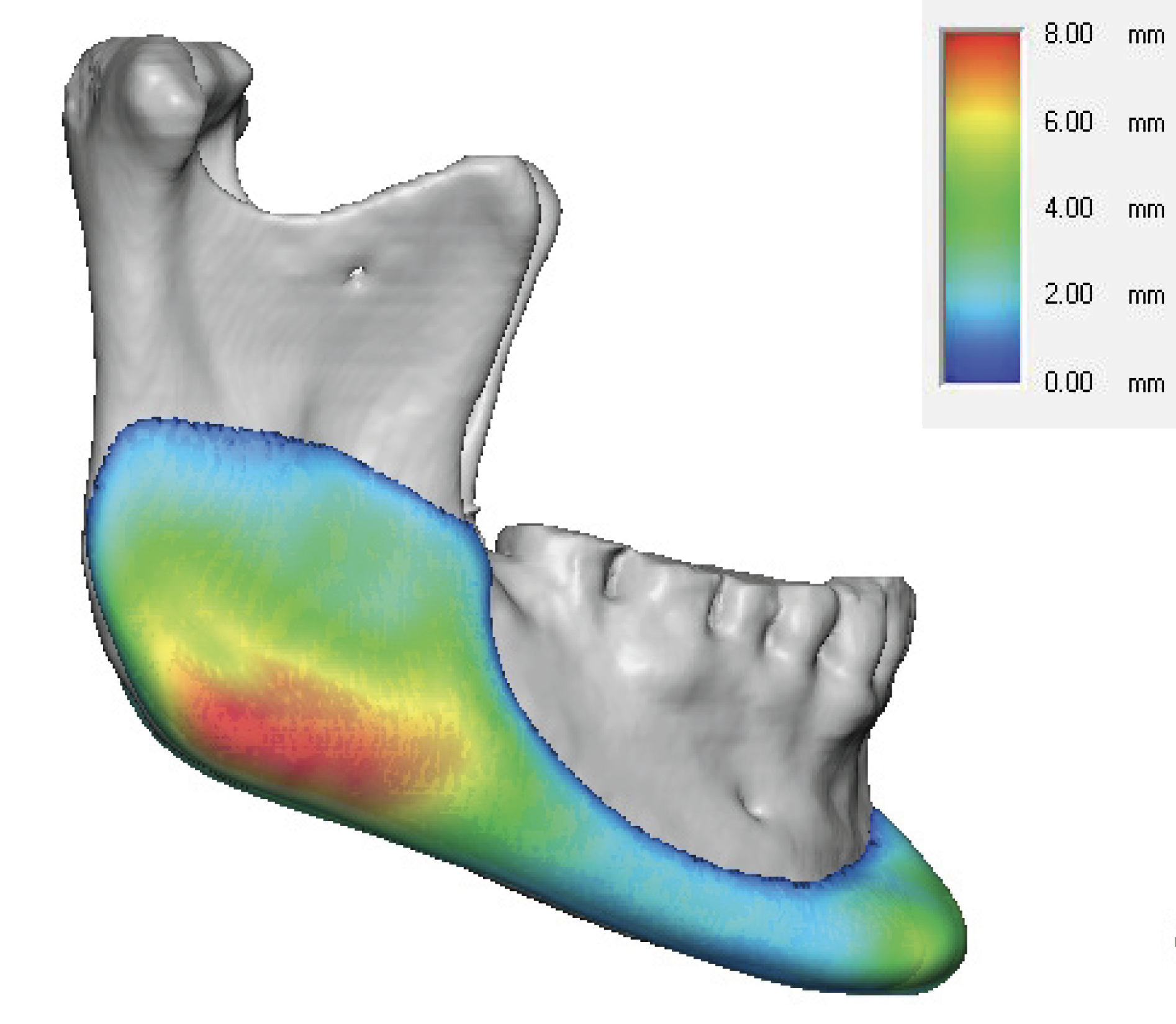 Custom Cheek and Jawline Implants for Male Masculinization - Explore ...