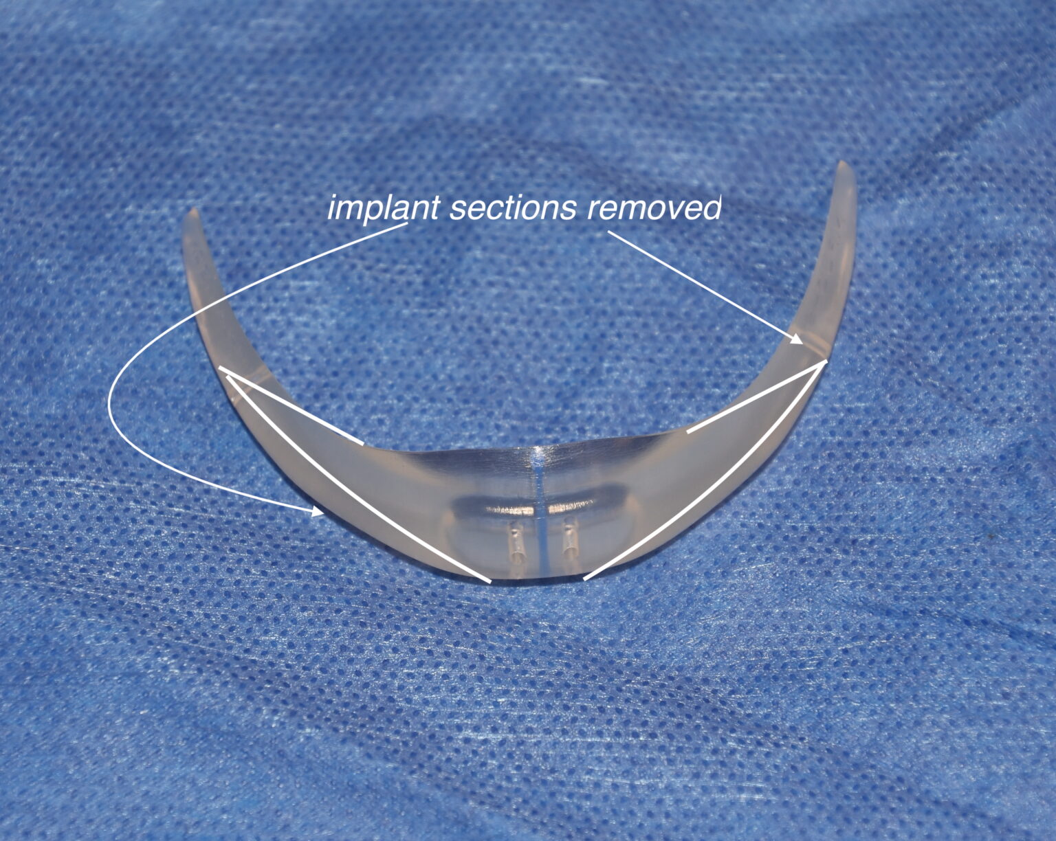 Technical Strategies - Intraoperative Fabrication of a True Female Chin ...