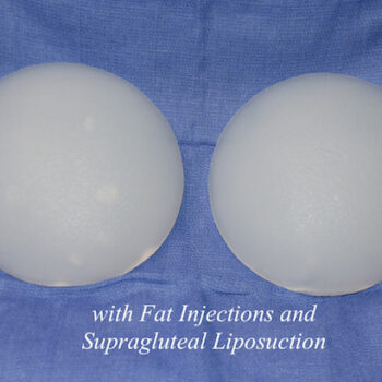 buttock augmentation Archives - Explore Plastic Surgery