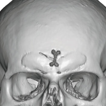 brow bone reduction Archives - Explore Plastic Surgery