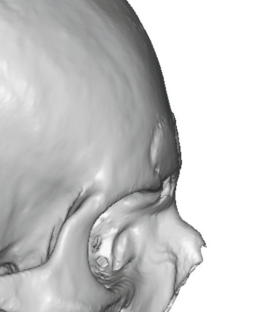 The Remarkable Healing Of The Bone Flap In Brow Bone Reduction Surgery ...