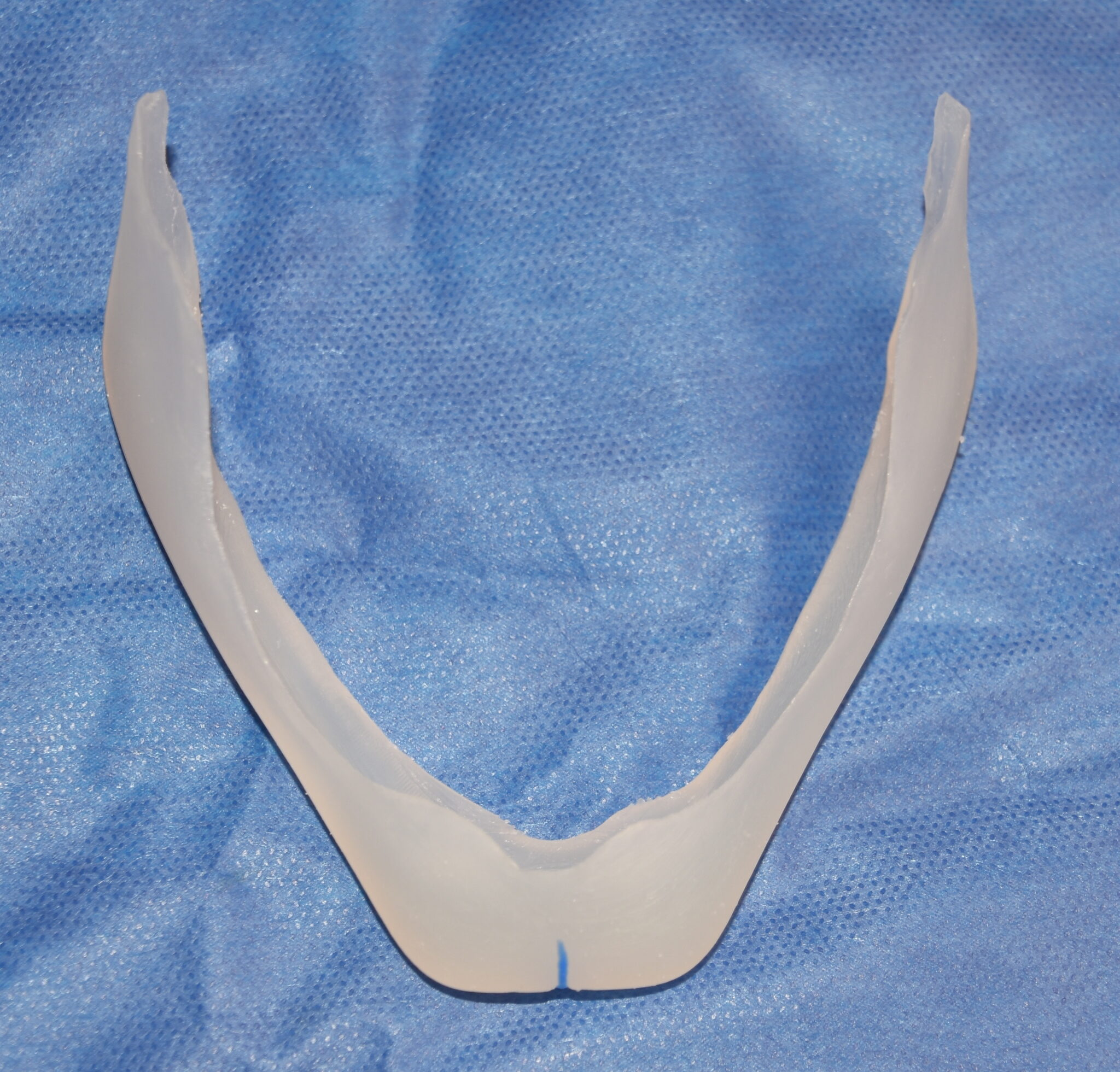 Plastic Surgery Case Study - Ensuring Soft Tissue Chin Pad Redraping in ...