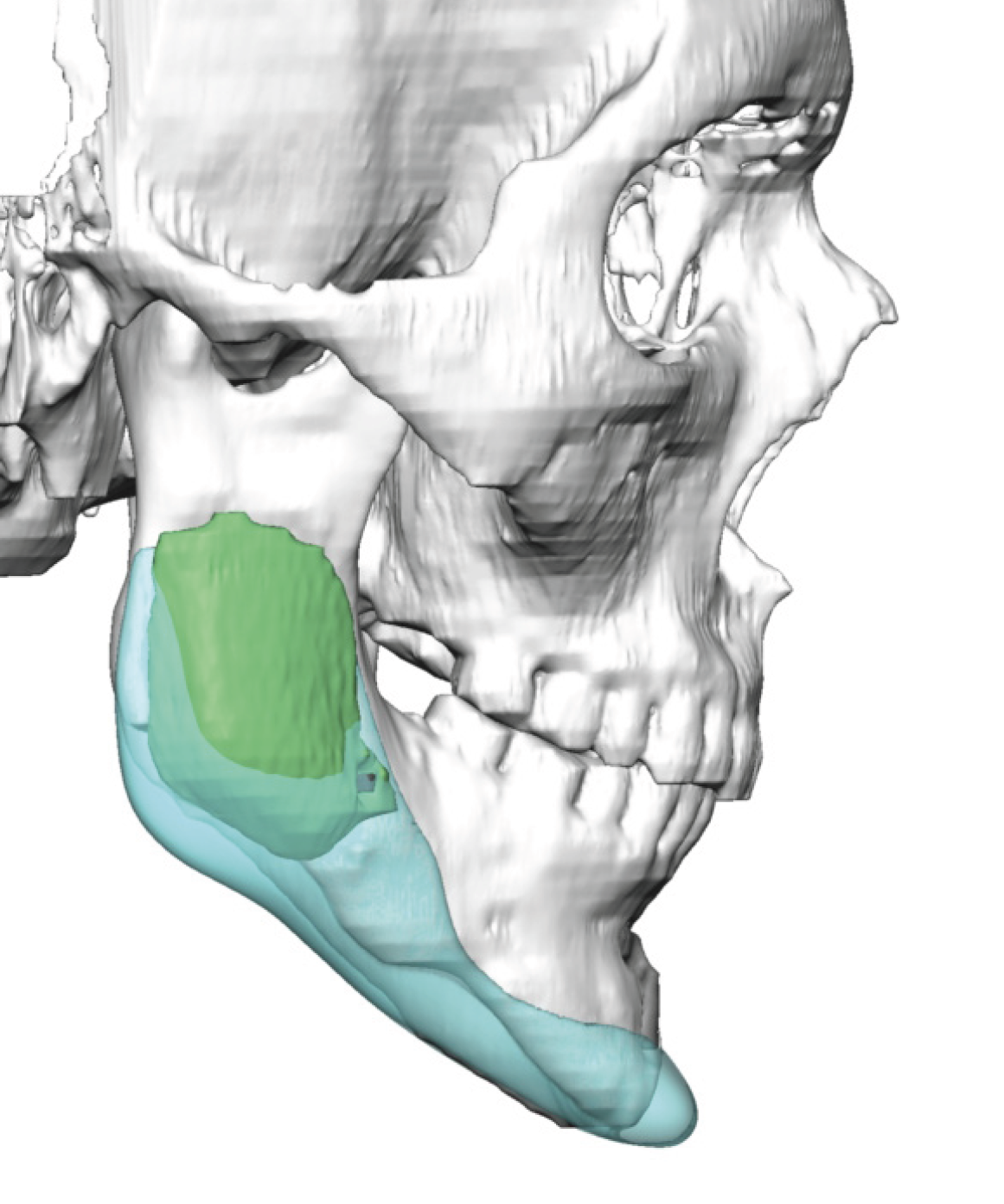 Plastic Surgery Case Study - Secondary Custom Jawline Implant For Jaw ...