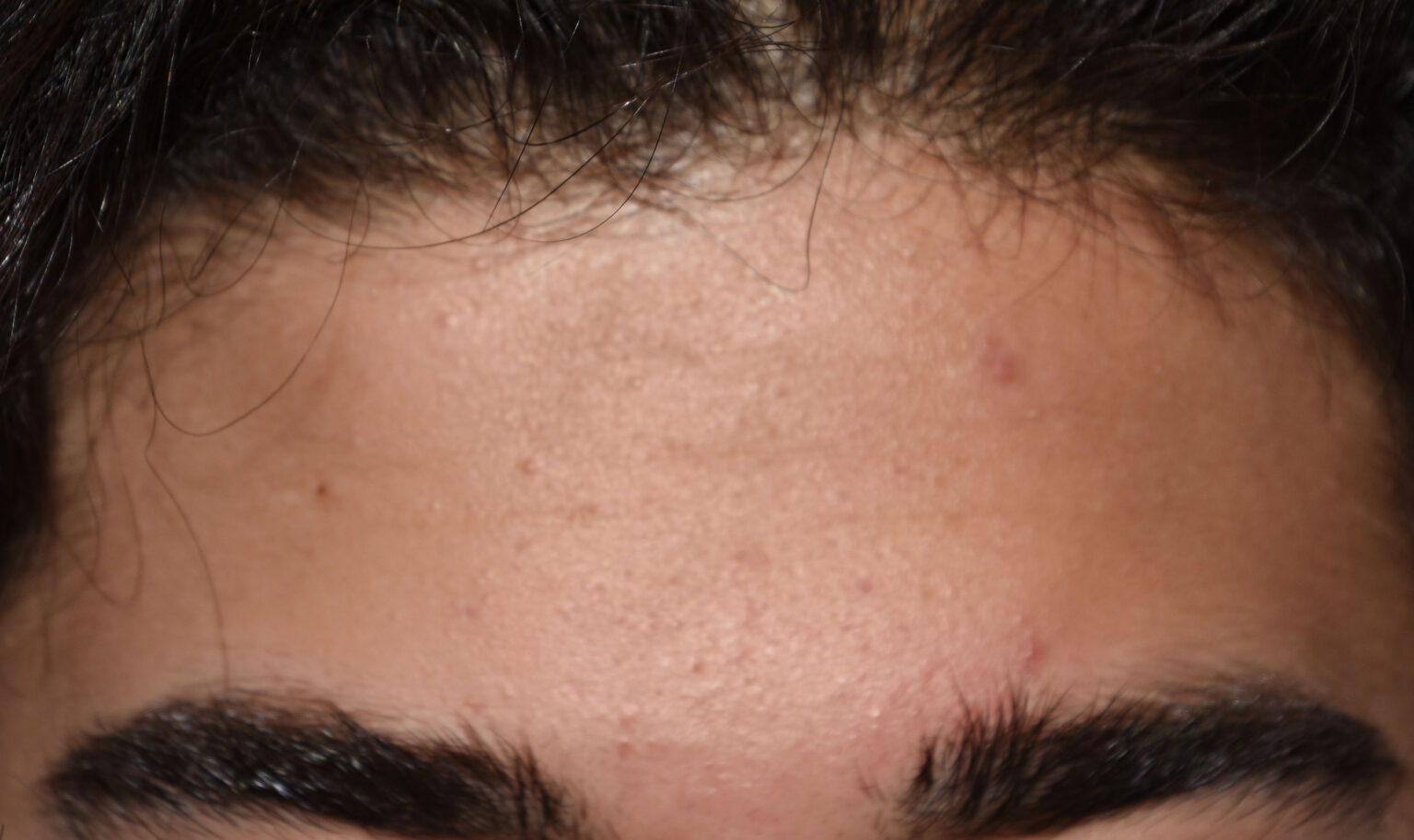 Plastic Surgery Case Study - Forehead Horn Reduction Using a Hair ...