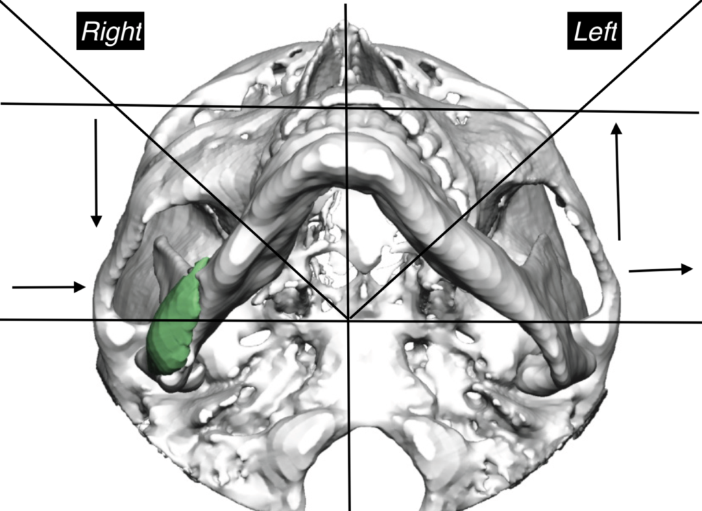Plastic Surgery Case Study - The Posterior Zygomatic Arch Osteotomy in ...