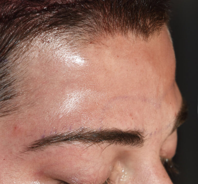 Plastic Surgery Case Study - Male Brow Bone Reduction Using A Limited ...