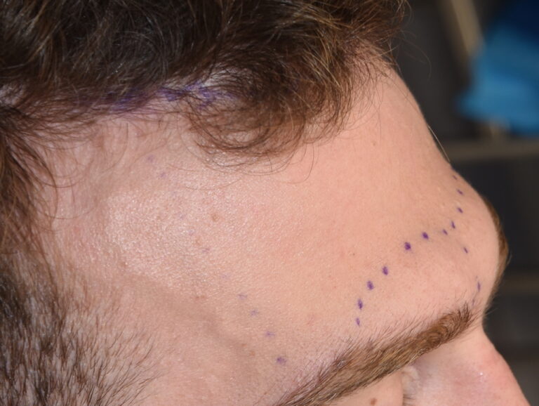 Plastic Surgery Case Study - Male Brow Bone Reduction Without Complete ...