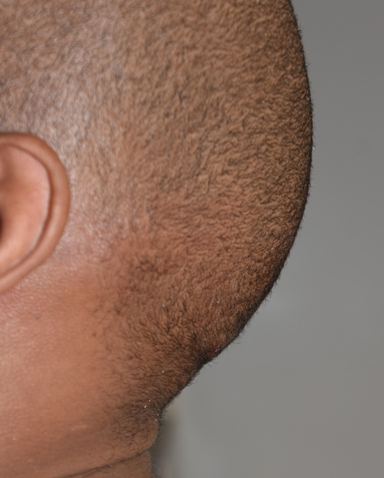 male occipital knob skull reduction intraop after side view Dr Barry ...