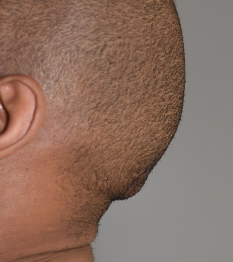 Plastic Surgery Case Study - Anatomic Bony Reduction In The Occipital ...