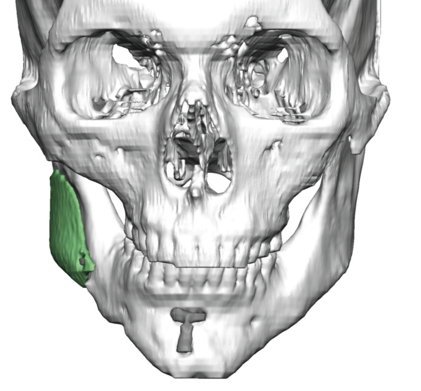 Plastic Surgery Case Study - Secondary Custom Jawline Implant For Jaw ...