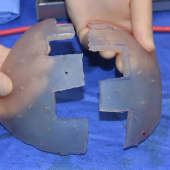 skull reshaping Archives - Page 13 of 40 - Explore Plastic Surgery