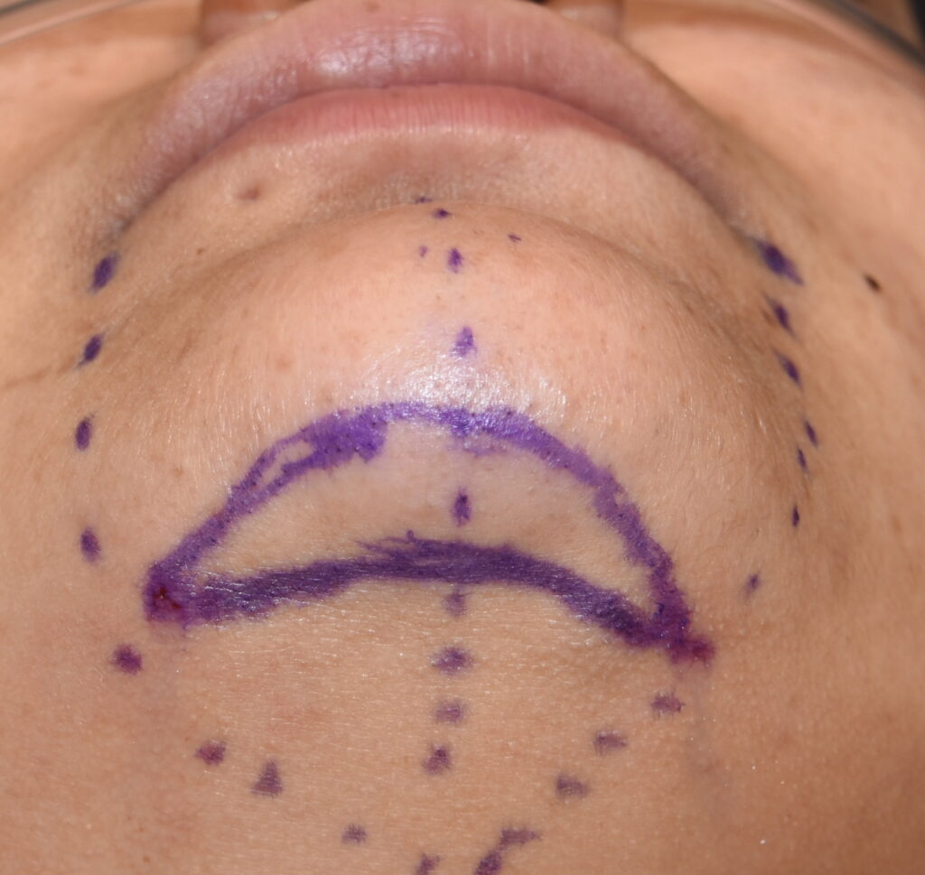 Plastic Surgery Case Study - Chin Reduction With Submental Resection Of ...