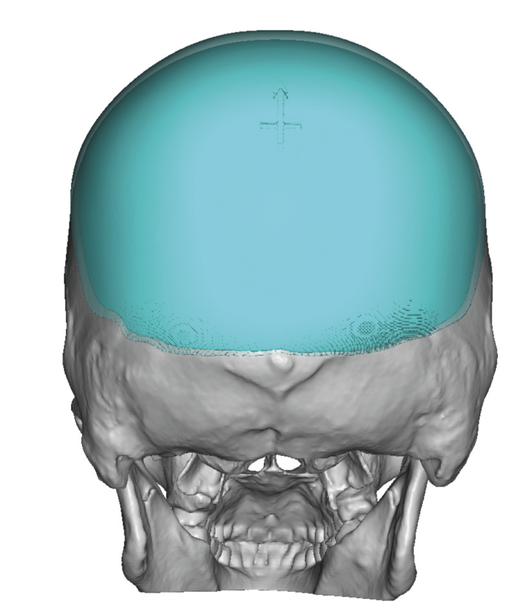 Plastic Surgery Case Study - Large Custom Two Layer Low Durometer Skull ...