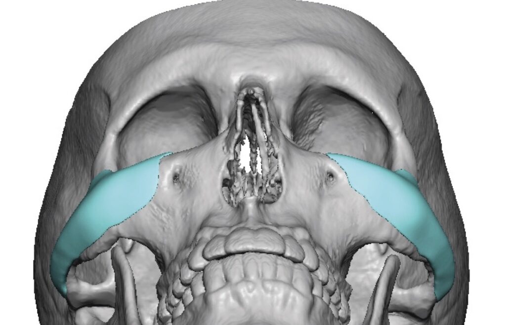 Male Hgh Cheekbone Implants design top view Dr Barry Eppley ...